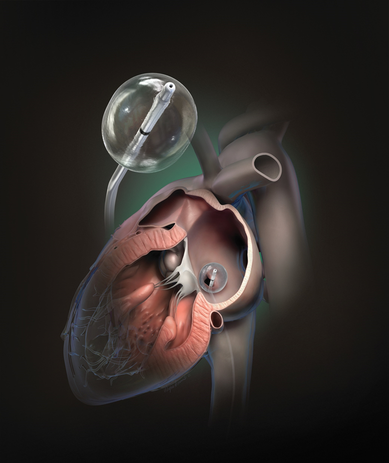 Z-6™ Atrioseptostomy Catheters